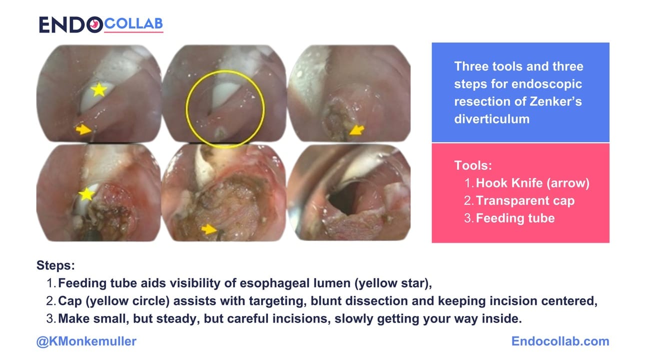 How I Do It: Endoscopic Resection of Zenker’s Diverticulum